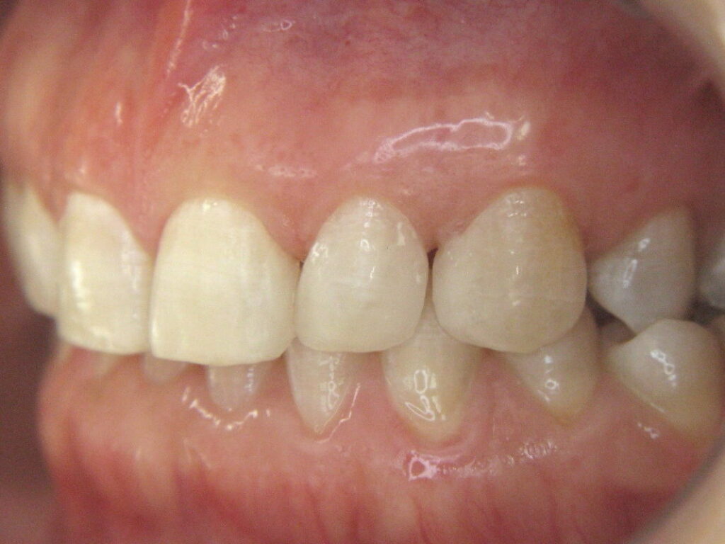 Vorher-Nachher - Zahnarztpraxis Dr. Zehnle